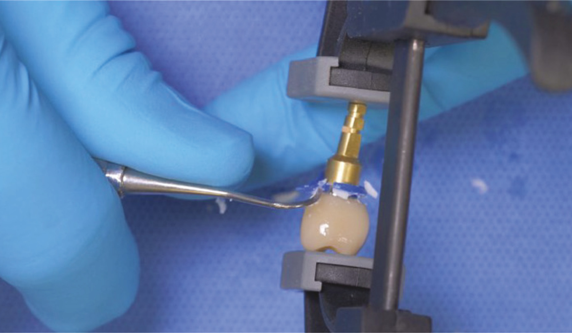 Titanium base implant cementation technique